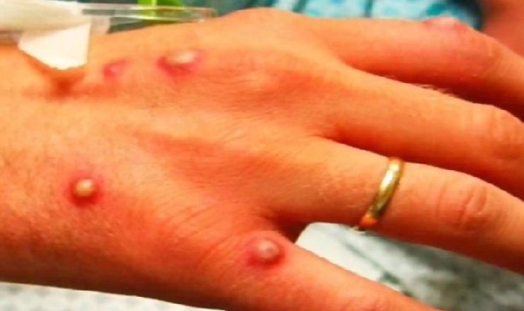 Потврдени случаи на мајмунски сипаници во Македонија-внимавајте ...